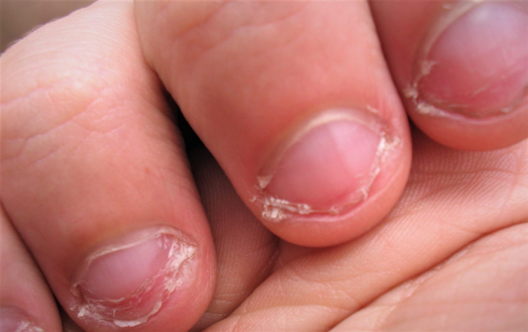 Roer as unhas é sinal de que sua saúde pode estar em perigo - Ideias Online